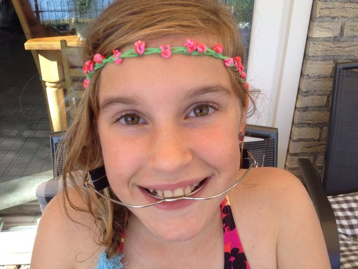 Pin By Larry Greenstein On Girls With Dental Braces And Headgear Teeth Braces Dental Braces