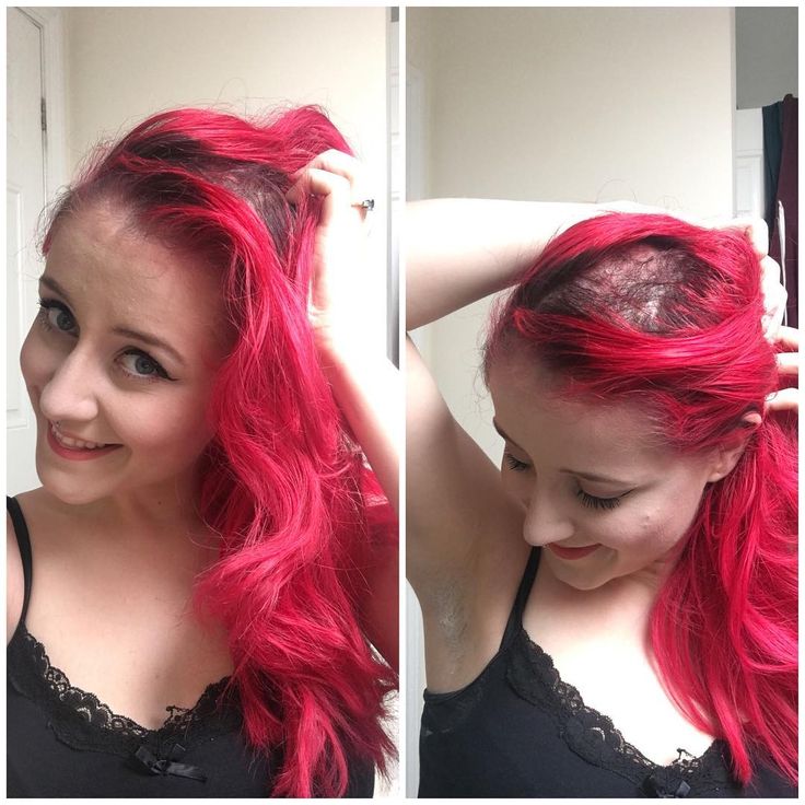 Hair Loss Was Scary But It Hasnt Made Me Any Less Beautiful Self