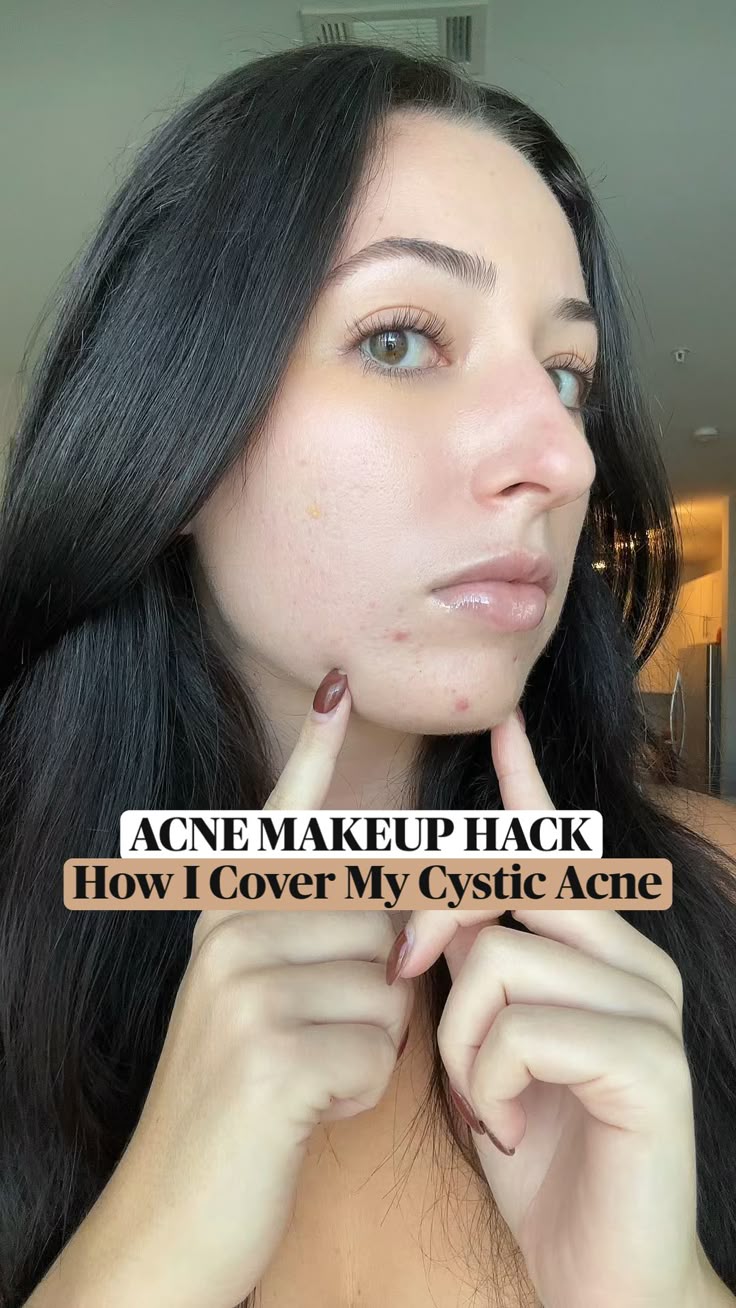 How I Cover My Cystic Acne Acne Makeup Hack Acne Makeup Makeup Routine Covering Acne With