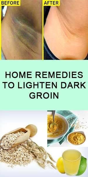 Home Remedies To Lighten Dark Groin Remedies Home Remedies Bikini Lightening Remedies