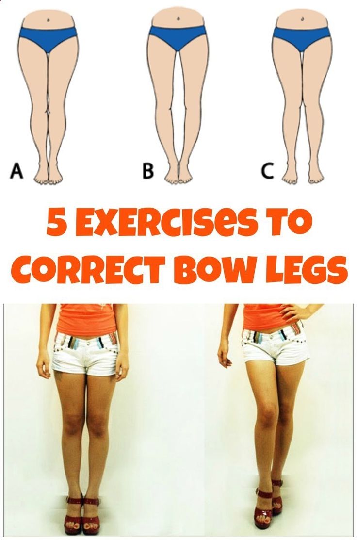 Bow Legs Correction Bow Legs Correction 5 Exercises To Correct Bow Legs Effective Program
