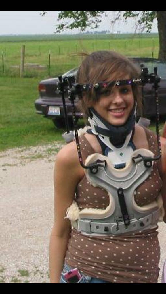 Flickrplgf9x4 Untitled Leg Braces Halo Brace Braces