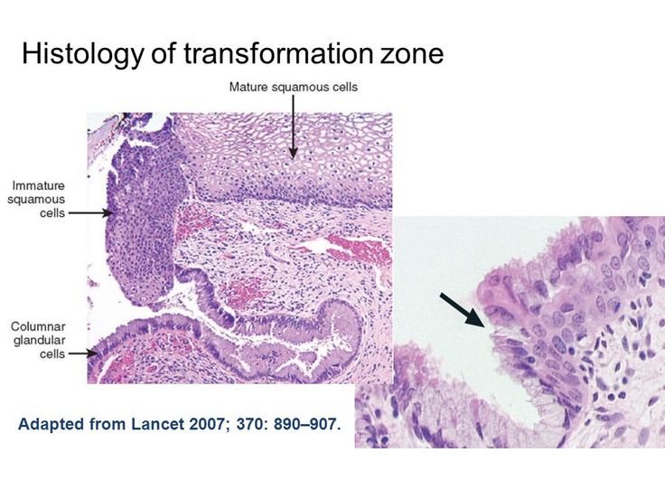 Endo And Ectocervix En 2022