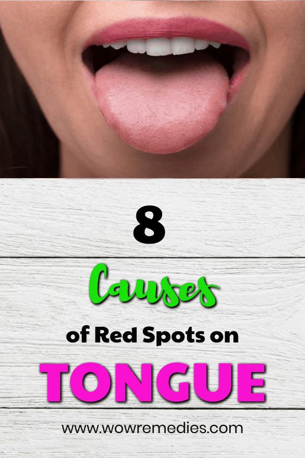 Red Spots On Tongue Causes And Treatment Bumps On Tongue Tongue Spot On