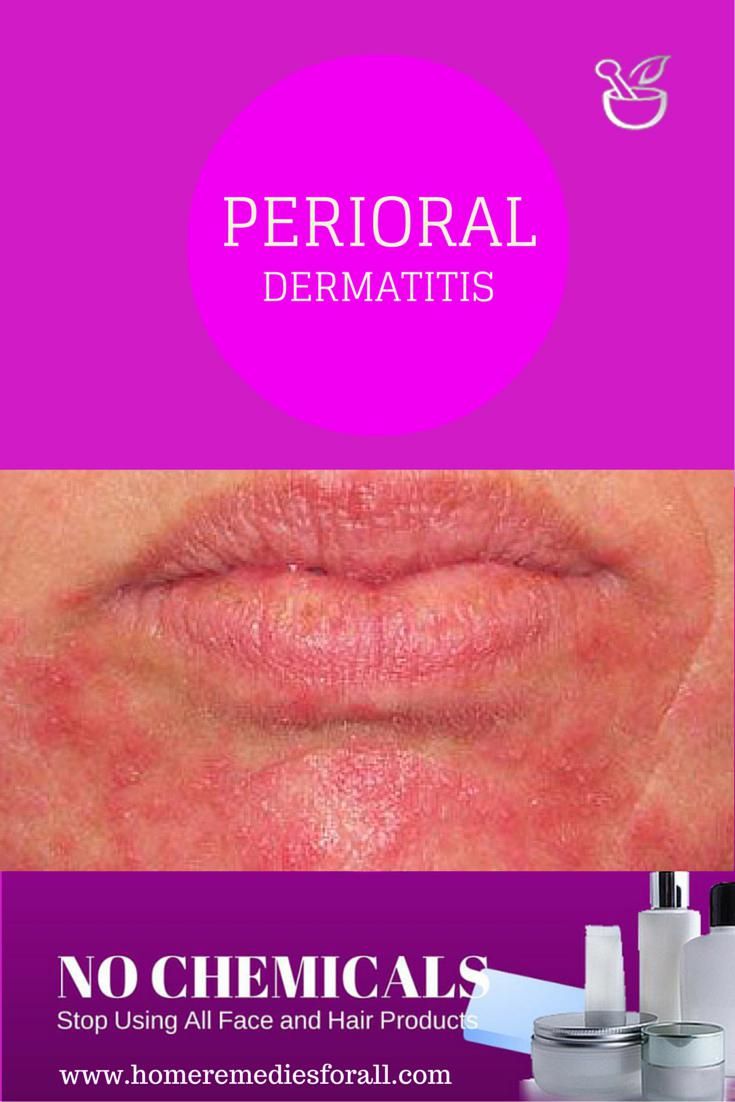 Home Remedies For Perioral Dermatitis Perioral Dermatitis Cure Perioral Dermatitis Treatment