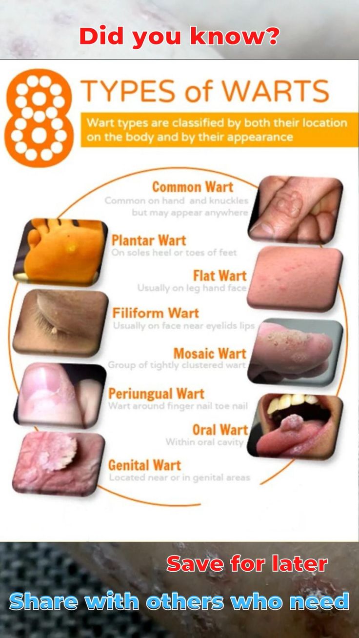 Types Of Warts Types Of Warts Flat Warts Filiform Wart