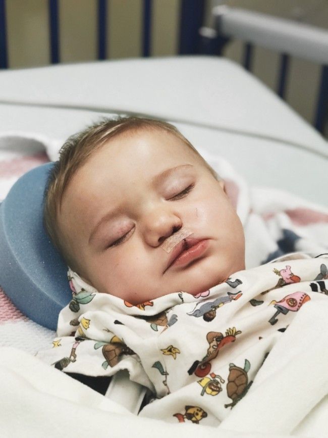 Our Cleft Lip And Palate Journey The Lip Repair Surgery