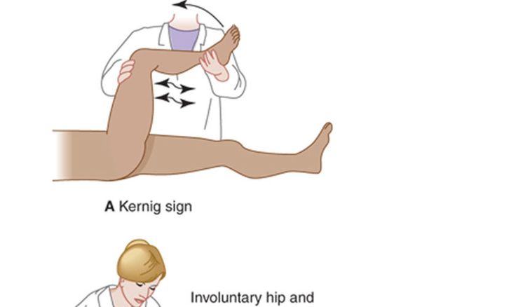 Learn About Kernig Sign And Brudzinski Sign How To Perform Kernig And