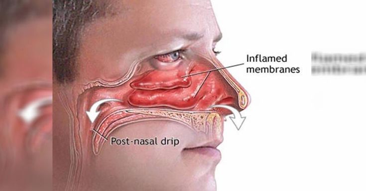 Pin On Nose Clean