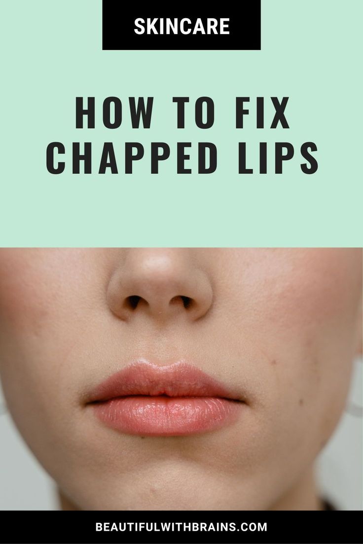 Chapped Lips 5 Ways To Heal Them Quickly Beautiful With Brains Chapped Lips Lips Treating