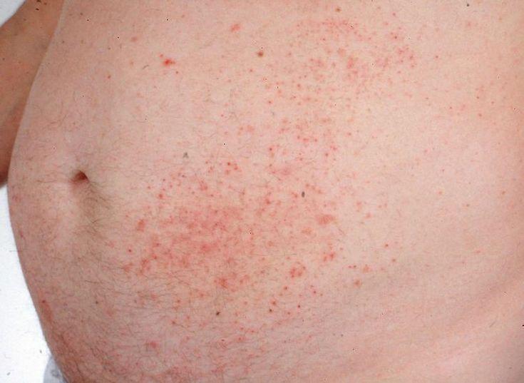 Rash Associated With Celiac Disease