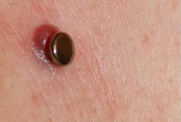 How To Get Rid Of Bump Beside Nose Piercing