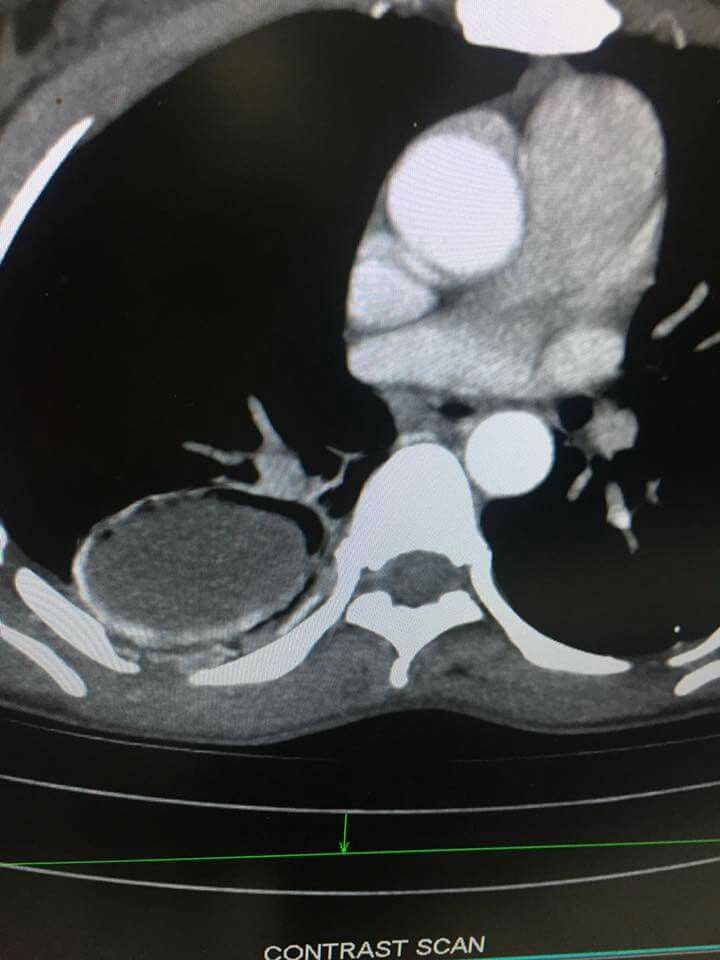 Aspergilloma Diagnostic Imaging Radiology Respiratory System