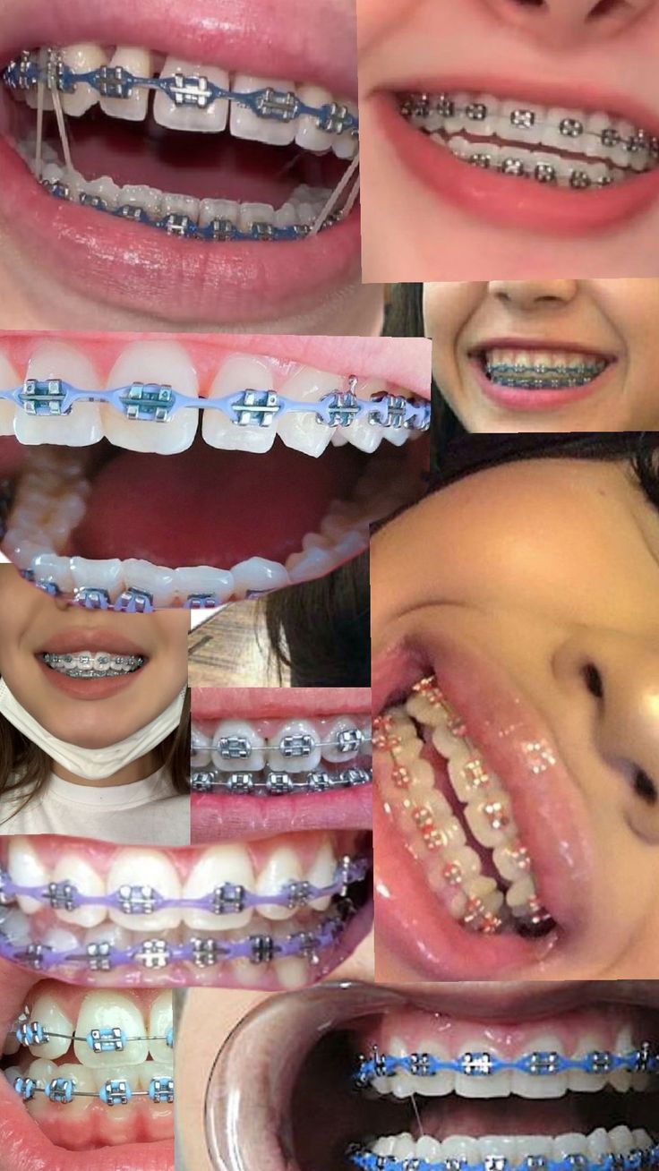 Pin By Miyathediva On Pretty Teeth Braces Colors Teeth Braces Cute Braces