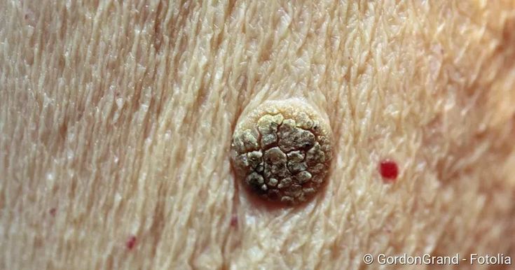 Seborrheic Keratosis (Senile warts): Complete Guide - Medical Society ... Seborrheic Keratosis (Senile warts): Complete Guide - Medical Society ...