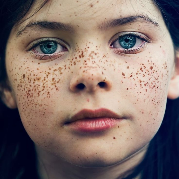 15 Personas Con Pecas Que Te Hipnotizarán Con Su Belleza única