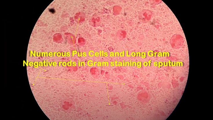 Long Gram Negative Rods And Numerous Pus Cells In Gram Stained Smear Of Sputum Microscopy