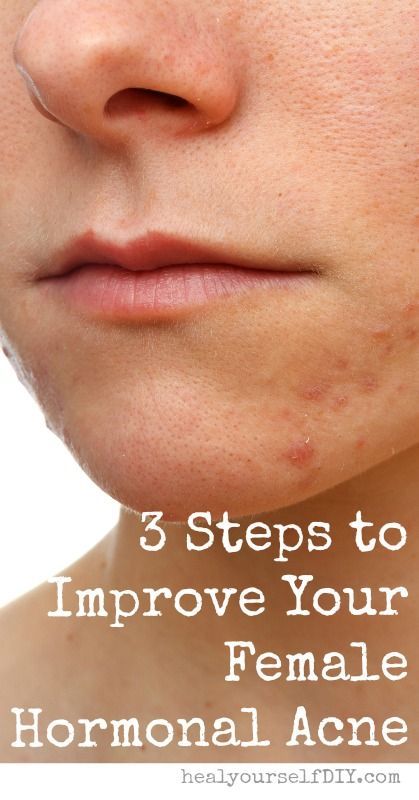 3 Steps To Improve Hormonal Acne Hormonal