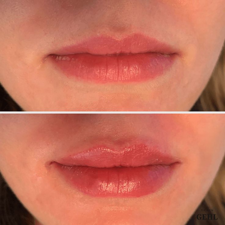 Botox® Lip Flip Lippen Ordination Dr Benjamin Gehl
