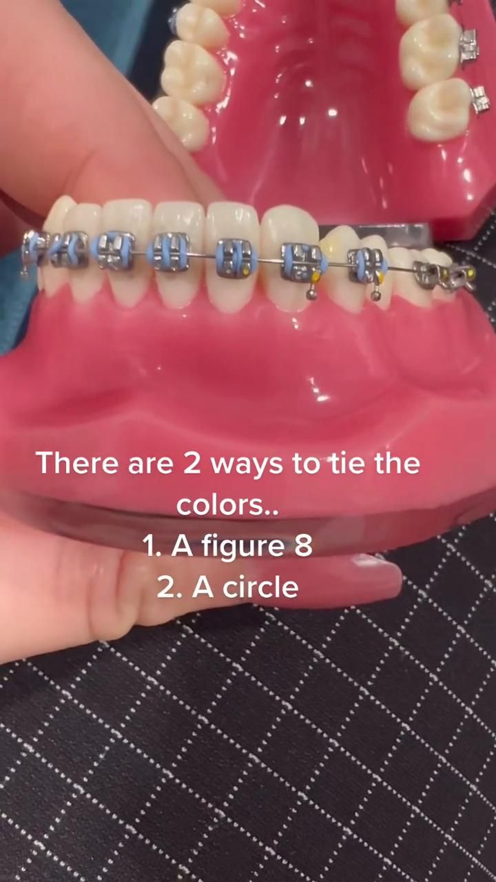 Can You Spot Which Is Which Braces Bracescolors Video Braces Colors Cute Braces Colors