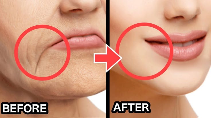 Jowl Exercises Face Lift Exercises Sagging Face Sagging Cheeks Chin