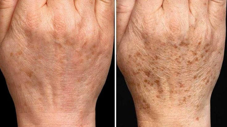 7 astuces pour se débarrasser naturellement des taches brunes sur la ... 7 astuces pour se débarrasser naturellement des taches brunes sur la ...