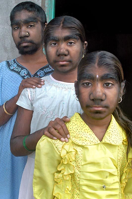 Rare Genetic Mutations In Humans