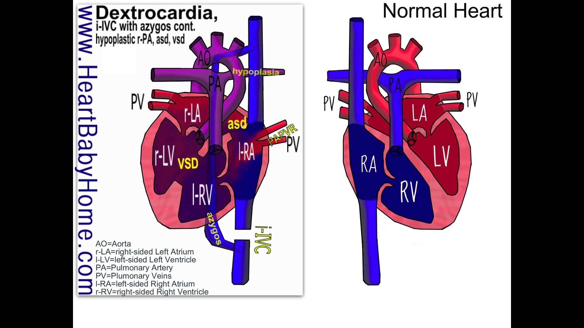 Heart Defect Video Explanation 55 Dextrocardia Papvr Azygos Continuation Via Youtube With