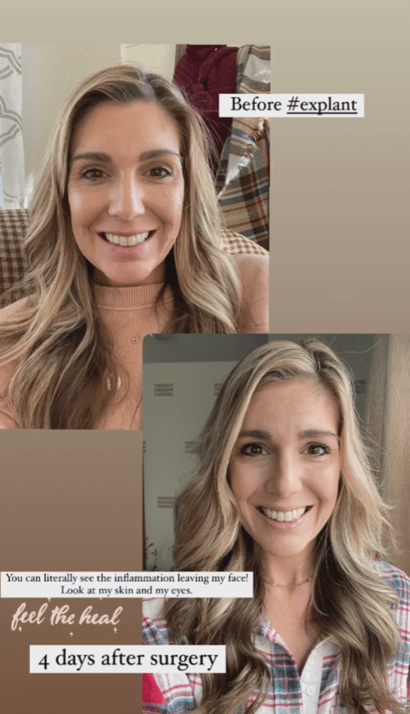 Explant Surgery My Journey To Recovery From Breast Implant Illness