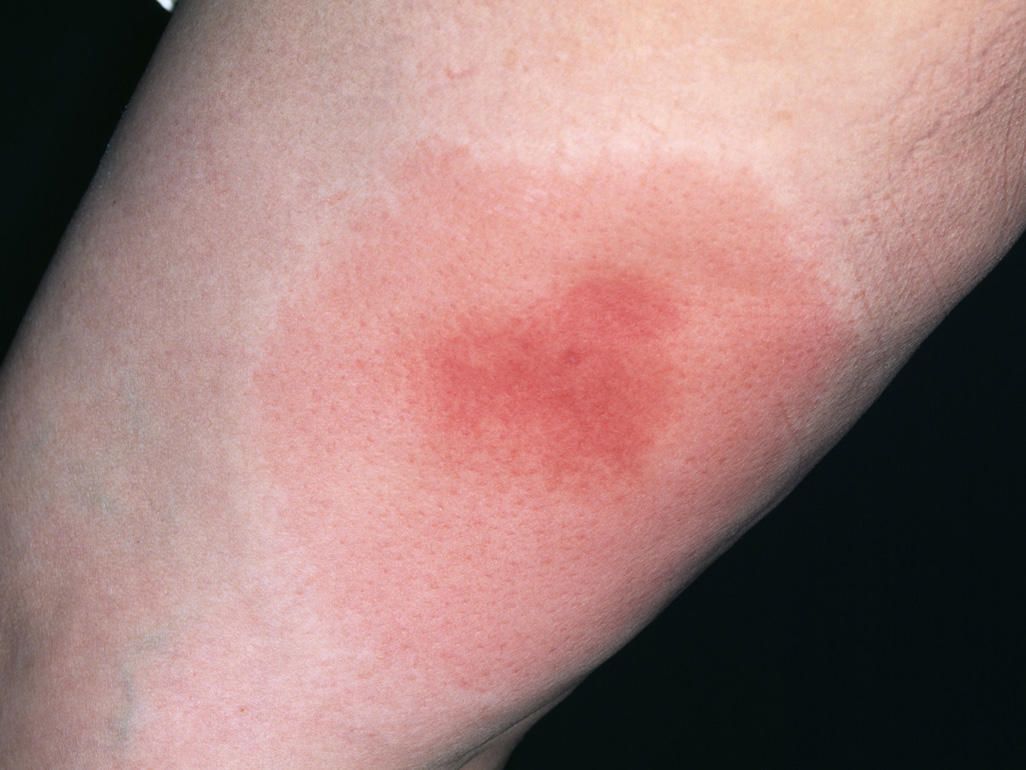 Bee Sting Allergic Reaction Rash
