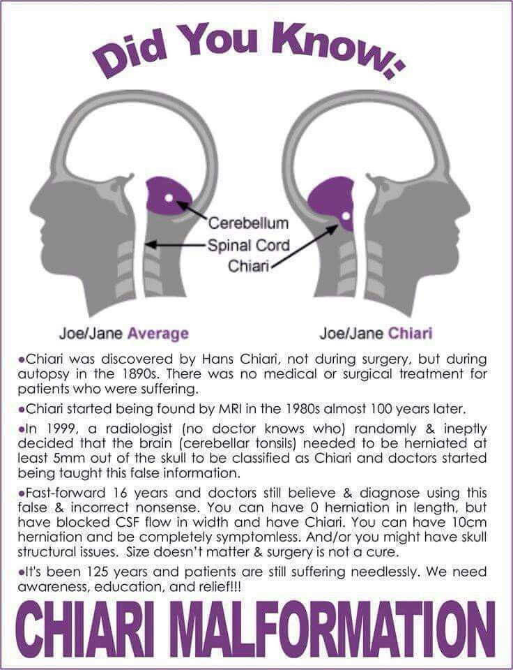 Epidermoid Cysts And How To Treat By Nancy Edwards This Newsletter Was Created With Smore An