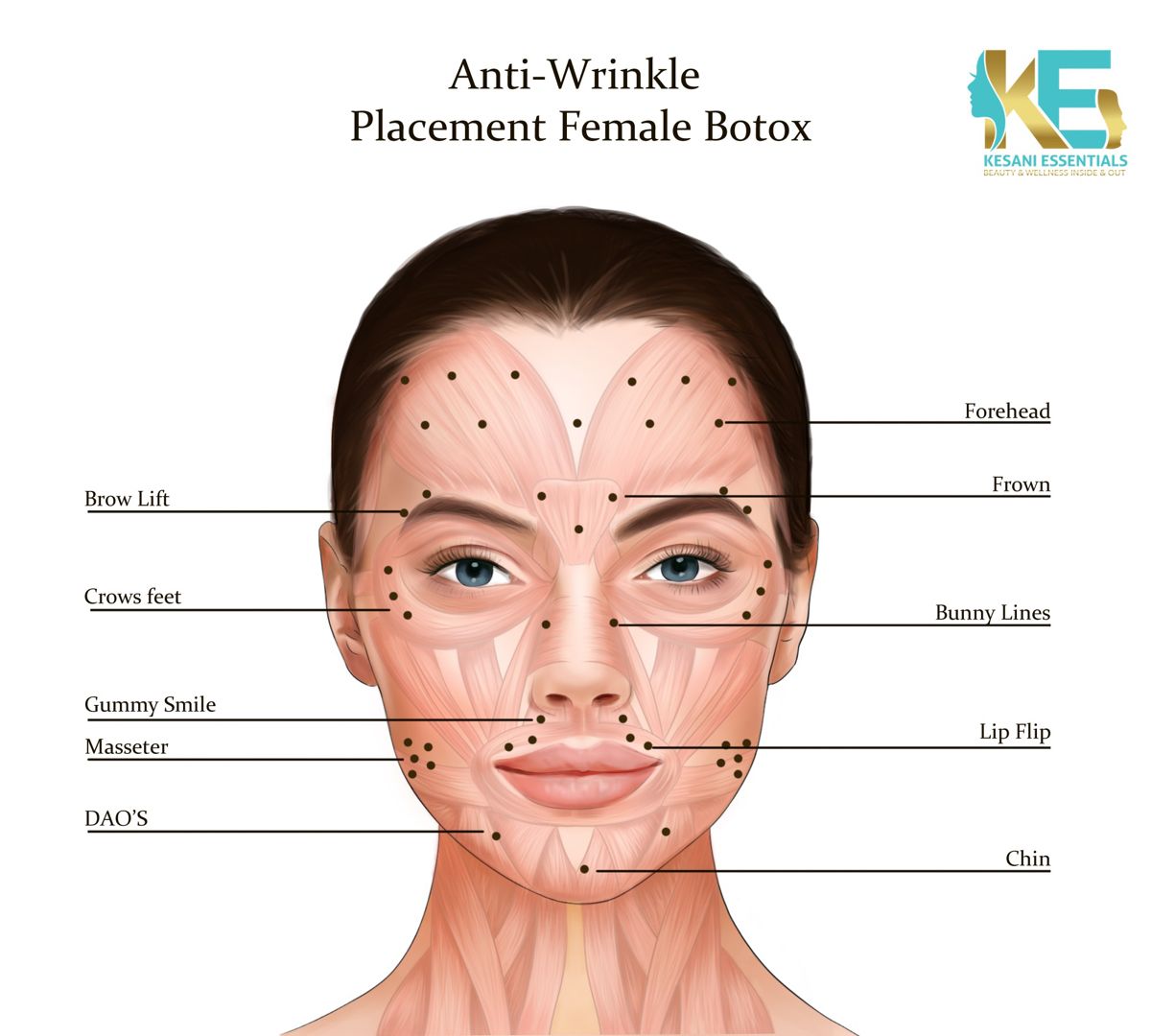 Botox placement | Botox injections, Botox, Botox injection sites Botox placement | Botox injections, Botox, Botox injection sites