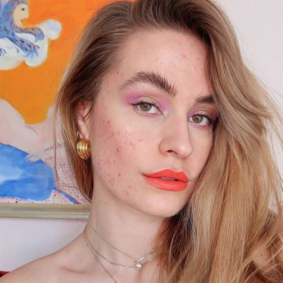 13 Skin Positive Acne Influencers Who Are Cool With Their Skin Exactly