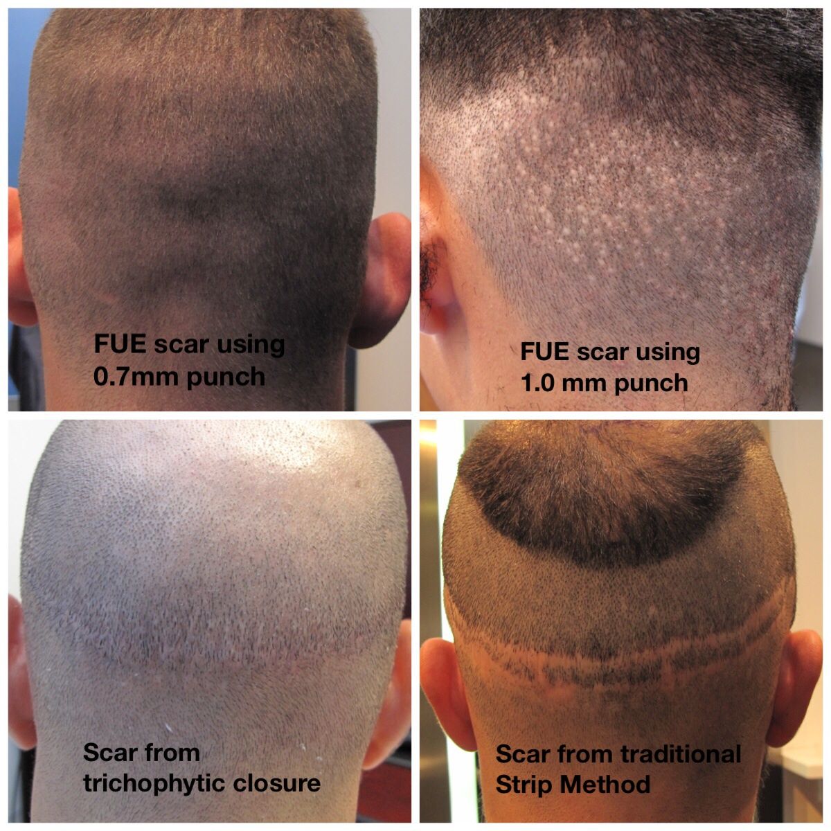 Hair Transplant Capelli Uomo Capelli