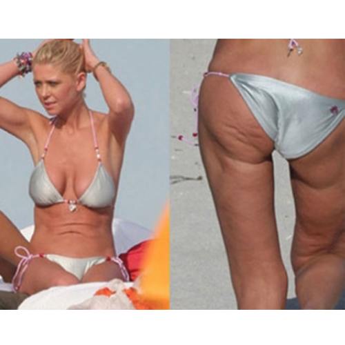 Pin On Cellulite