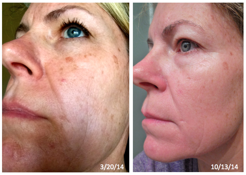 Achieve Firmer Skin And Diminish Sun Spots