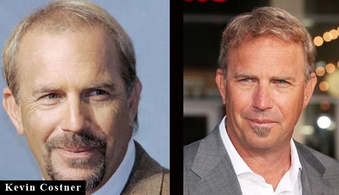 Kevin Costner Trasplante De Cabello Cabello Famosos