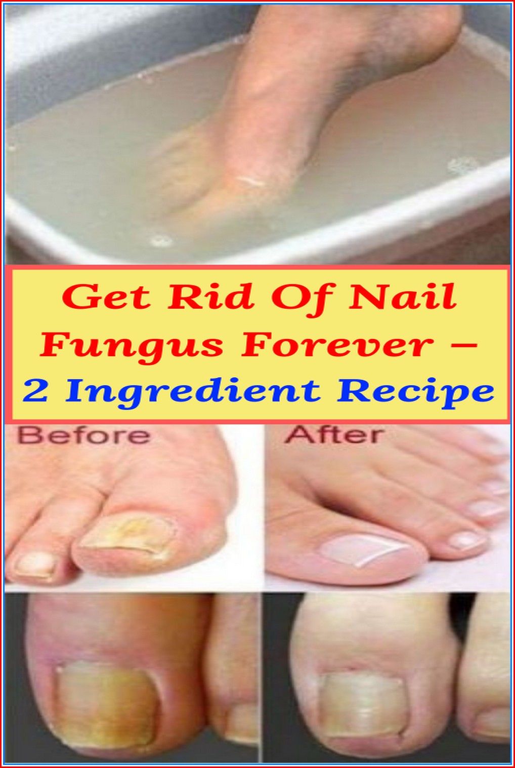 Pin On Fungus Ads1 Artofit