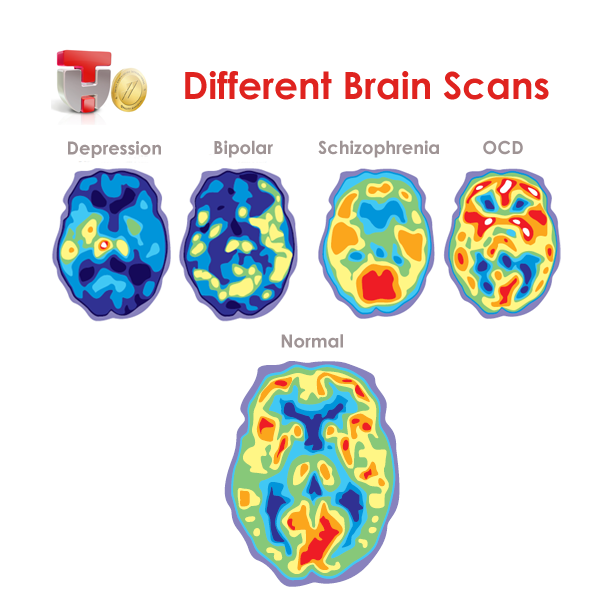 What is schizophrenia types symptoms causes and complications of ... What is schizophrenia types symptoms causes and complications of ...