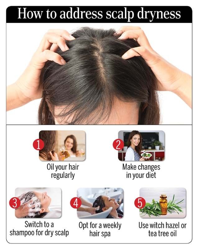 How To Get Rid Of Dry Scalp Dry Flaky Scalp Dry Scalp Shampoo For Dry Scalp