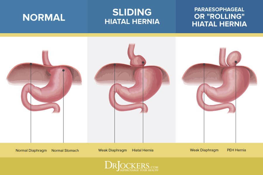 Hiatal Hernia Symptoms Causes Natural Support Strategies Artofit