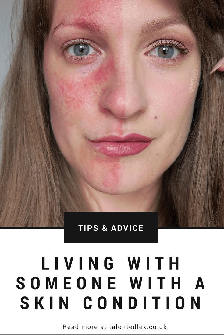 Living With Someone With Rosacea Tips And Advice Vaseline Beauty Tips
