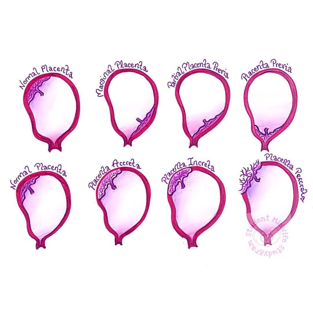 Placenta Variations And What They Look Like Nursing S