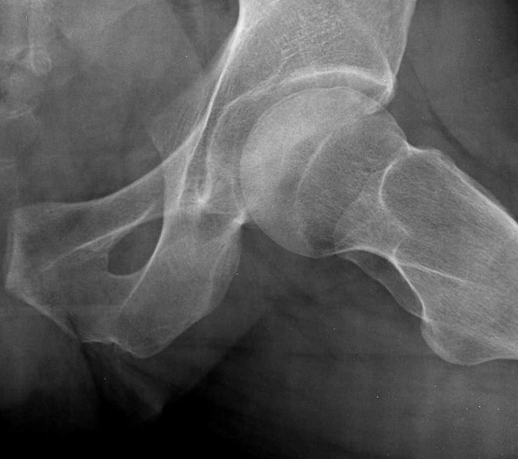 Crescent Sign Of Femoral Head Avascular Necrosis Radiology Case Avascular