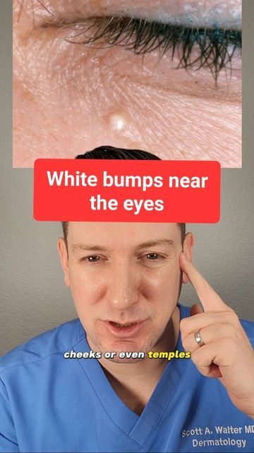 Scott Walter Md Faad On Instagram Have You Ever Wondered What Those Little White Or Yellow