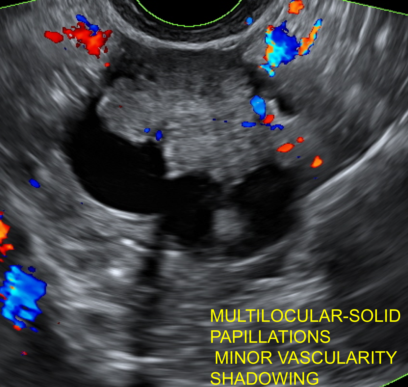 Ovarian Endometrioid Adenocarcinoma Medical Ultrasound Ultrasound Ultrasound Tech