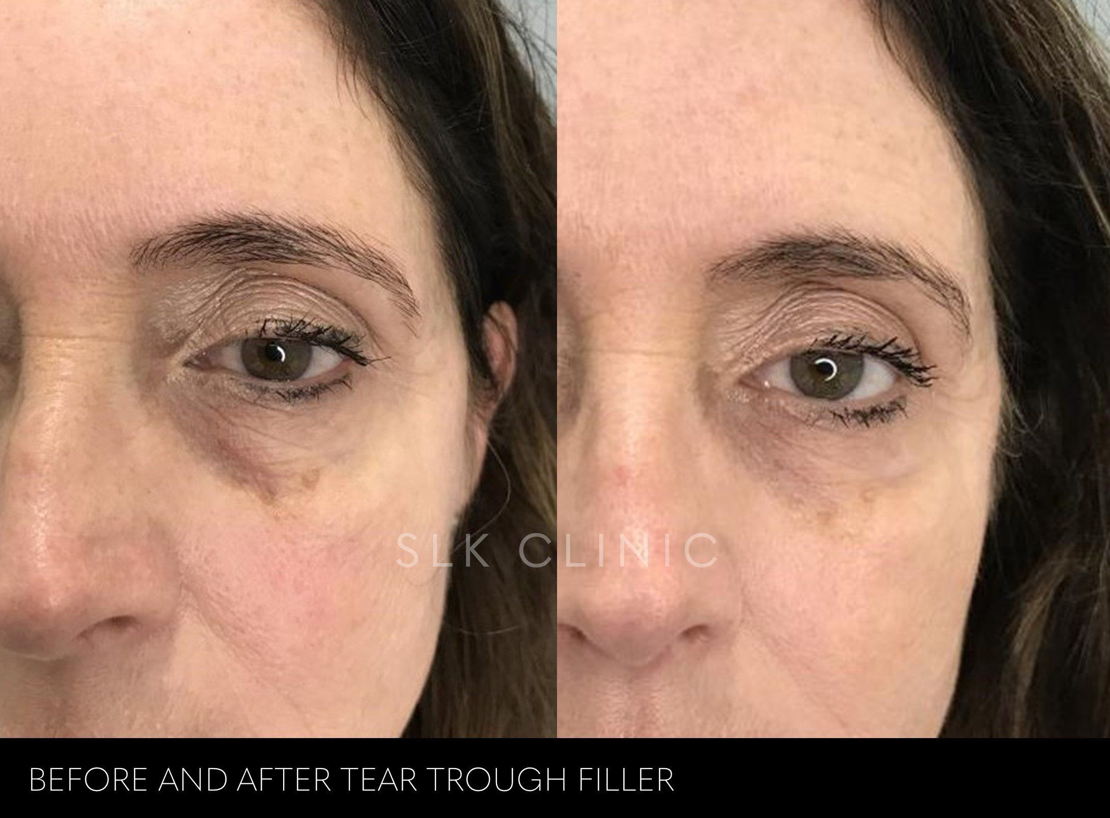 Fillers For Eye Bags