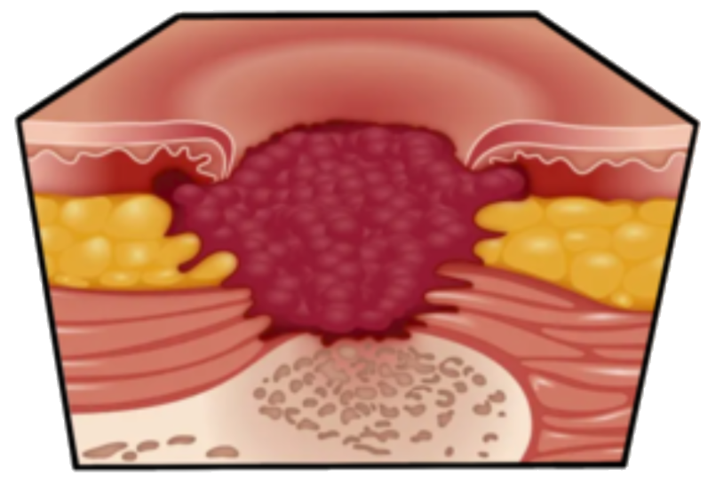 Stages Of Pressure Ulcers Stages Treatments And More Artofit